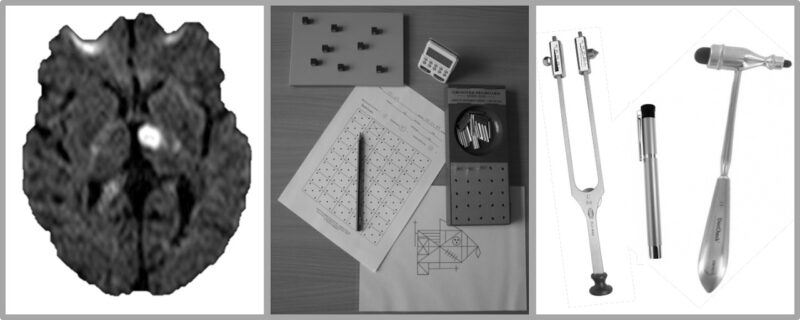 Secondary neurodegeneration after strategic brain infarcts with ...